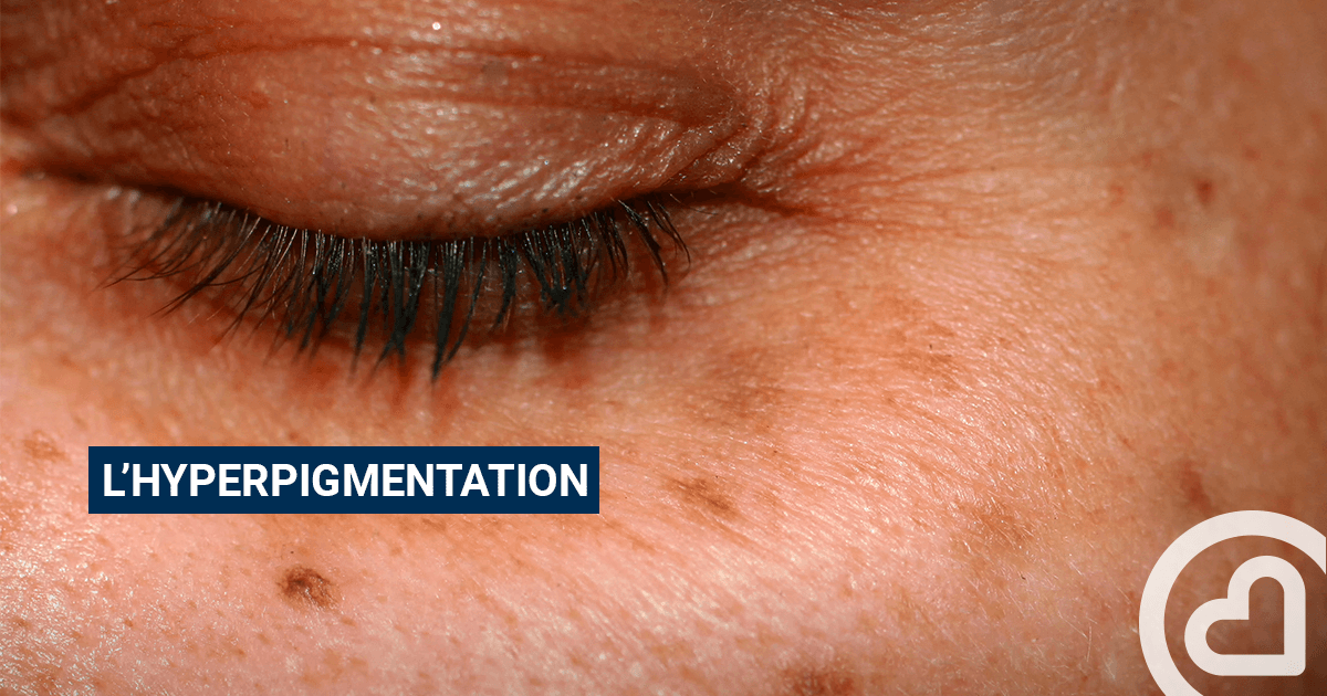 L’hyperpigmentation – Familiprix