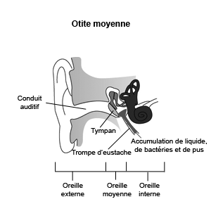 L'otite moyenne – Familiprix